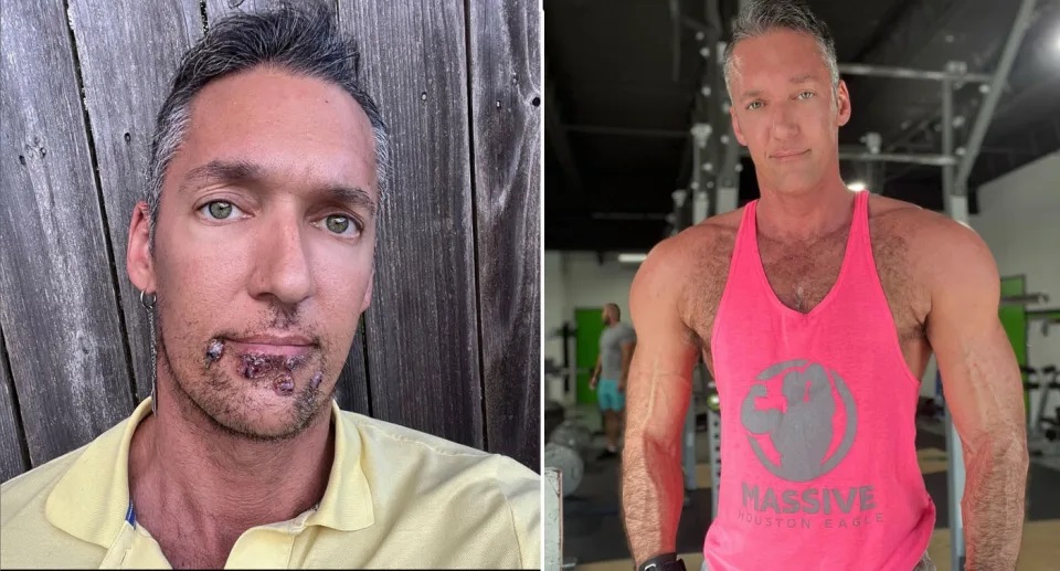 Male Performer Silver Steele documents his bout with frightening STD